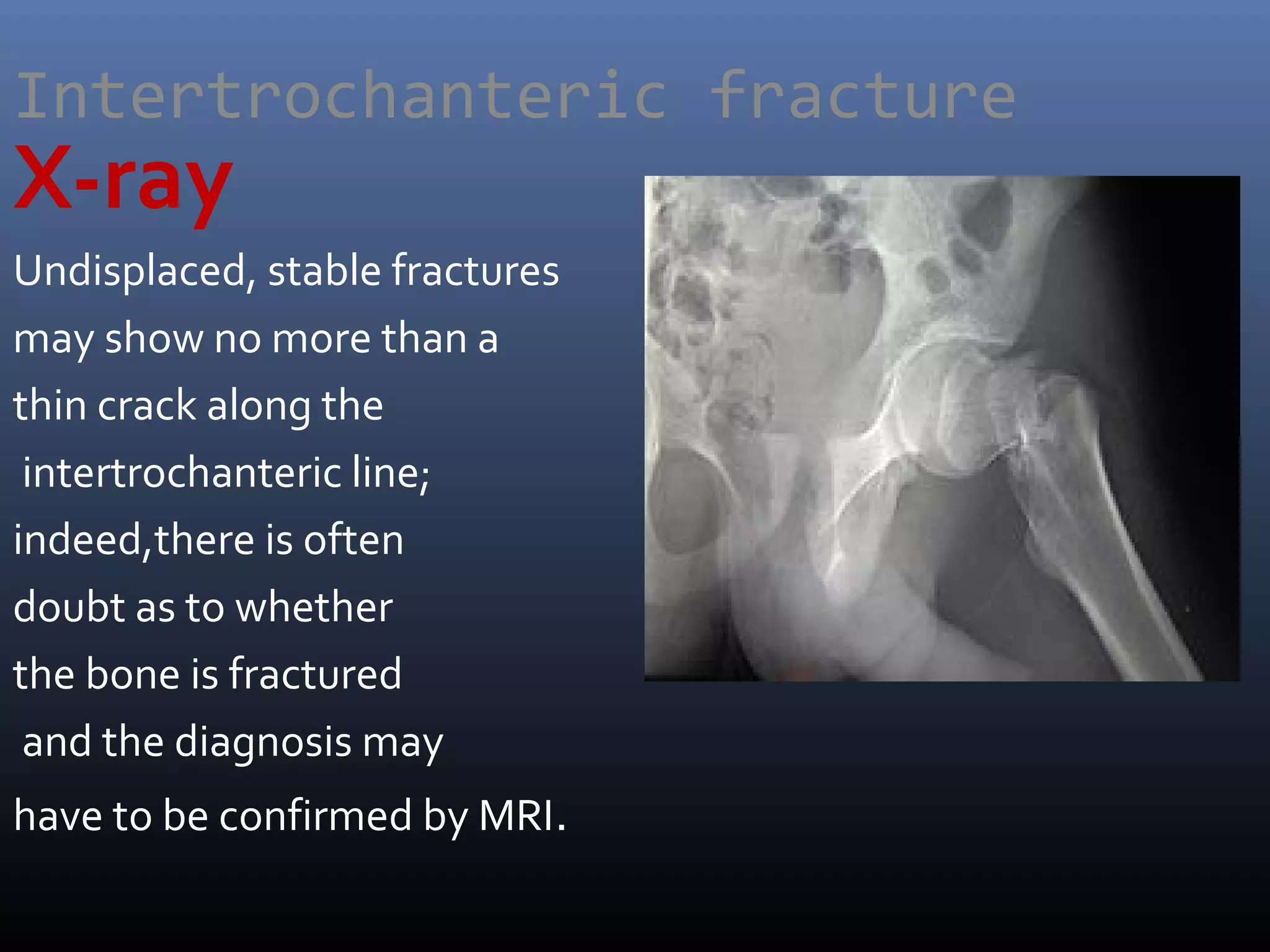 Intertrochanteric fracture | PPT