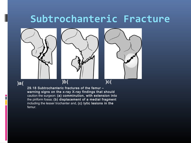 Intertrochanteric fracture | PPT