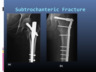 Intertrochanteric fracture | PPT