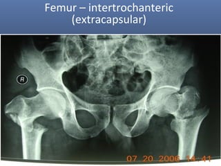 Intertrochanteric fracture | PPT