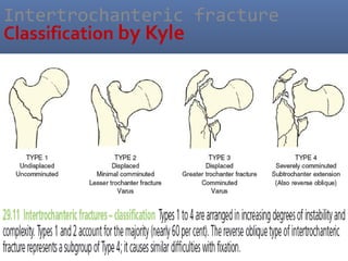 Intertrochanteric fracture | PPT