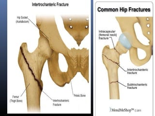Comminuted Intertrochanteric Fracture