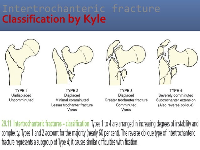 Intertrochanteric fracture