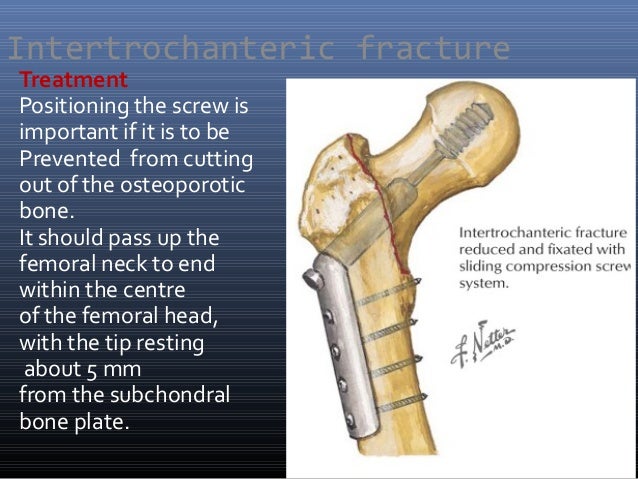 Intertrochanteric fracture