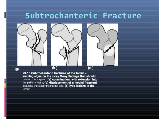 Intertrochanteric fracture