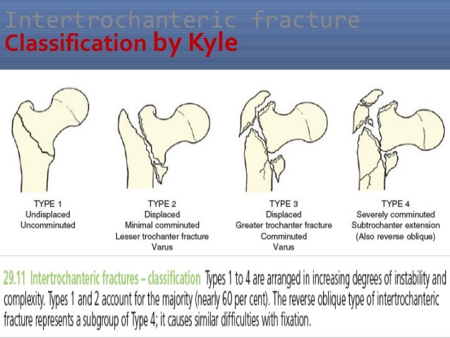 Intertrochanteric fracture