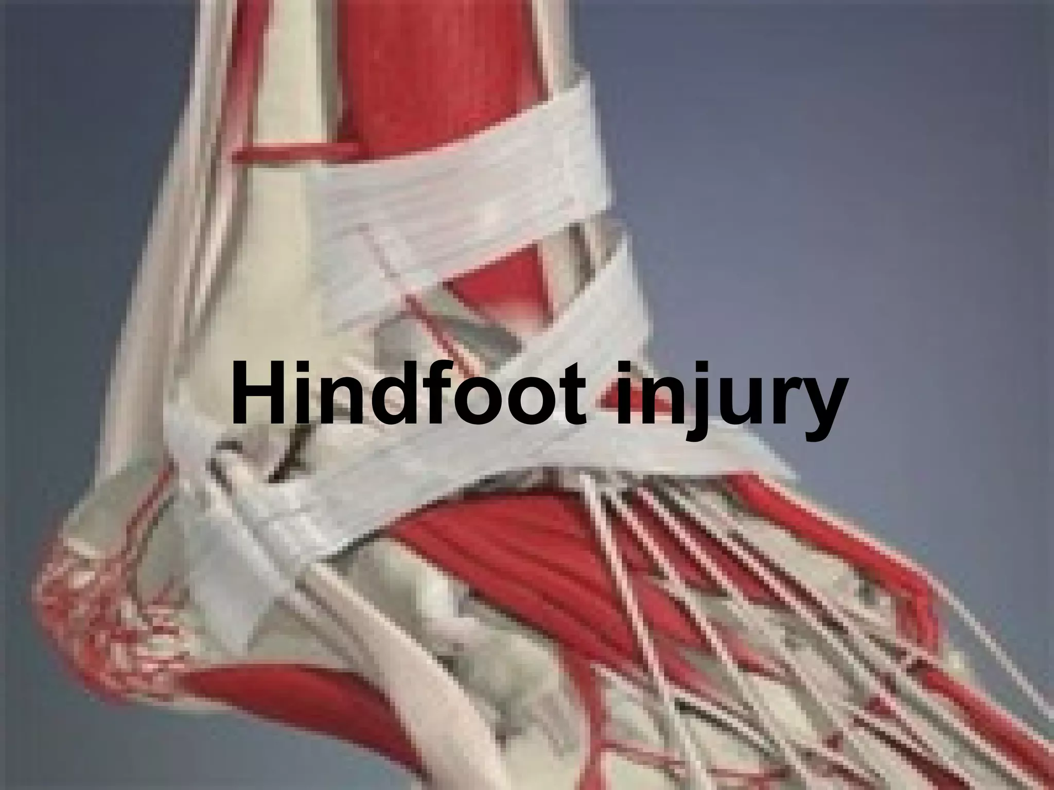 Hindfoot injury | PPT