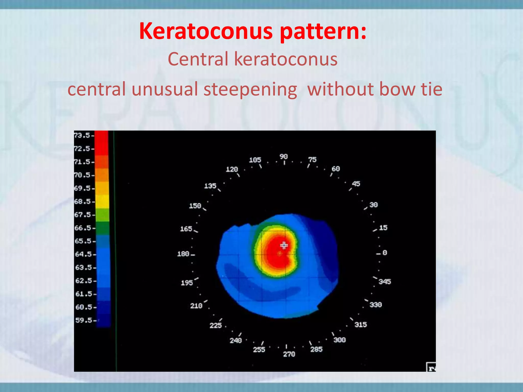 keratoconus | PPT