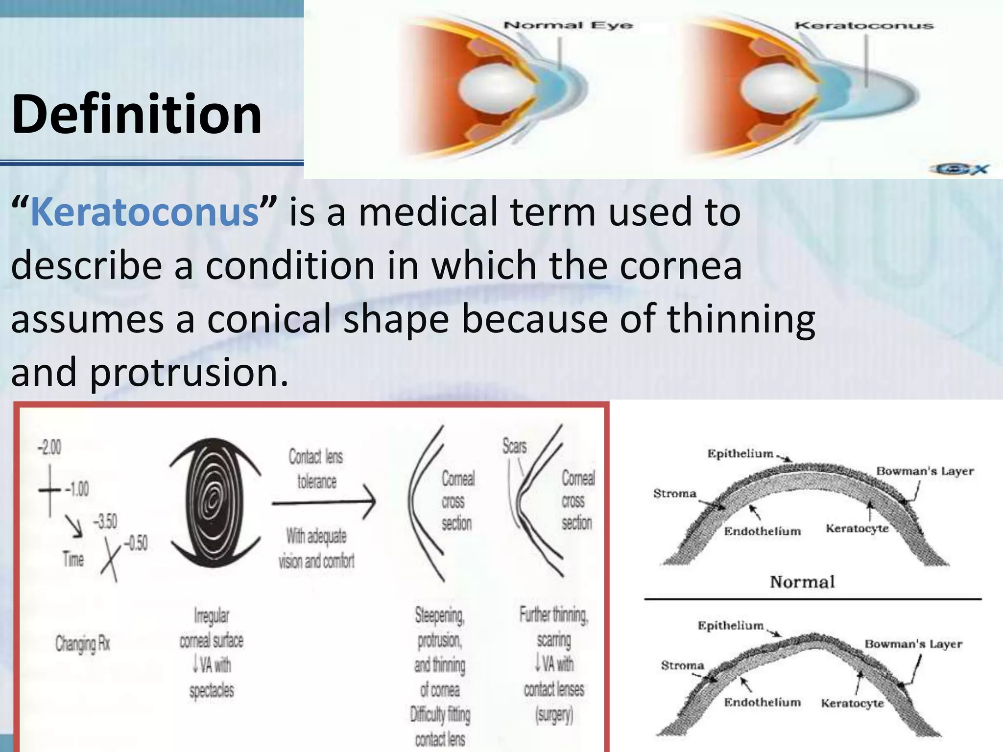 keratoconus | PPTX