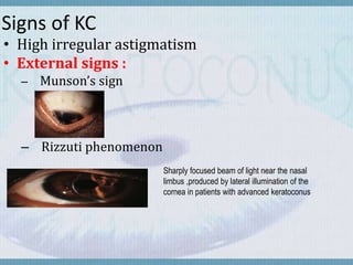 Rizzuti Sign Keratoconus