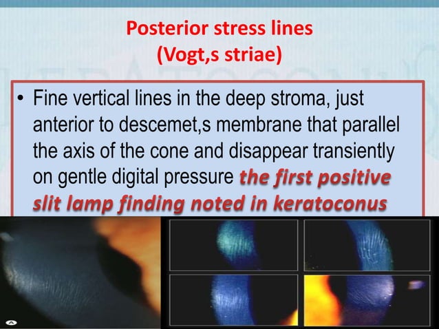 keratoconus | PPT