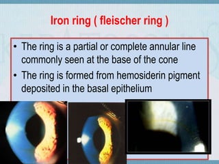 Fleischers Ring Keratoconus