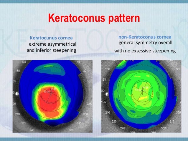 keratoconus