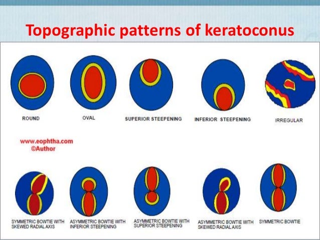 keratoconus