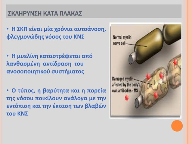 σκληρυνση κατα πλακας | PPT | Free Download