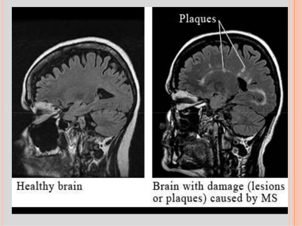 σκληρυνση κατα πλακας