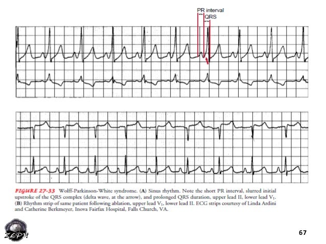 Зүрхний хэм алдагдал