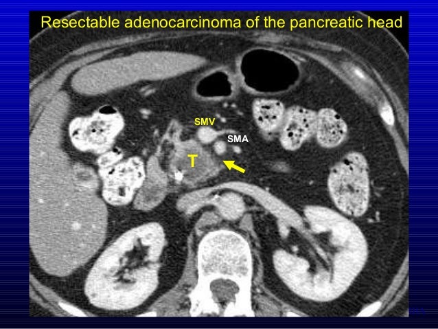 Surgical Treatment of Pancreatic Cancer - Dimitris P. Korkolis