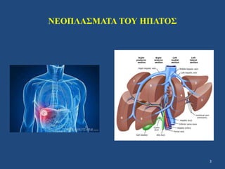 Νεόπλασμα του Ήπατος | PPTX