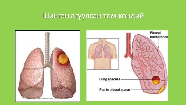 уушиг тогших үзлэг
