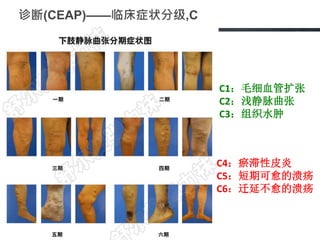 Chronic Venous Disease 下肢静脉功能不全简介 | PPTX