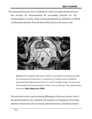 mri of rectal cancer | PPTX
