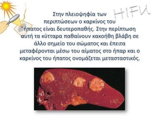 καρκίνος του ήπατος | PPSX