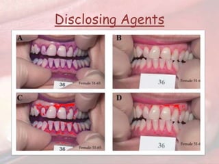 Dental plaque formation | PPTX