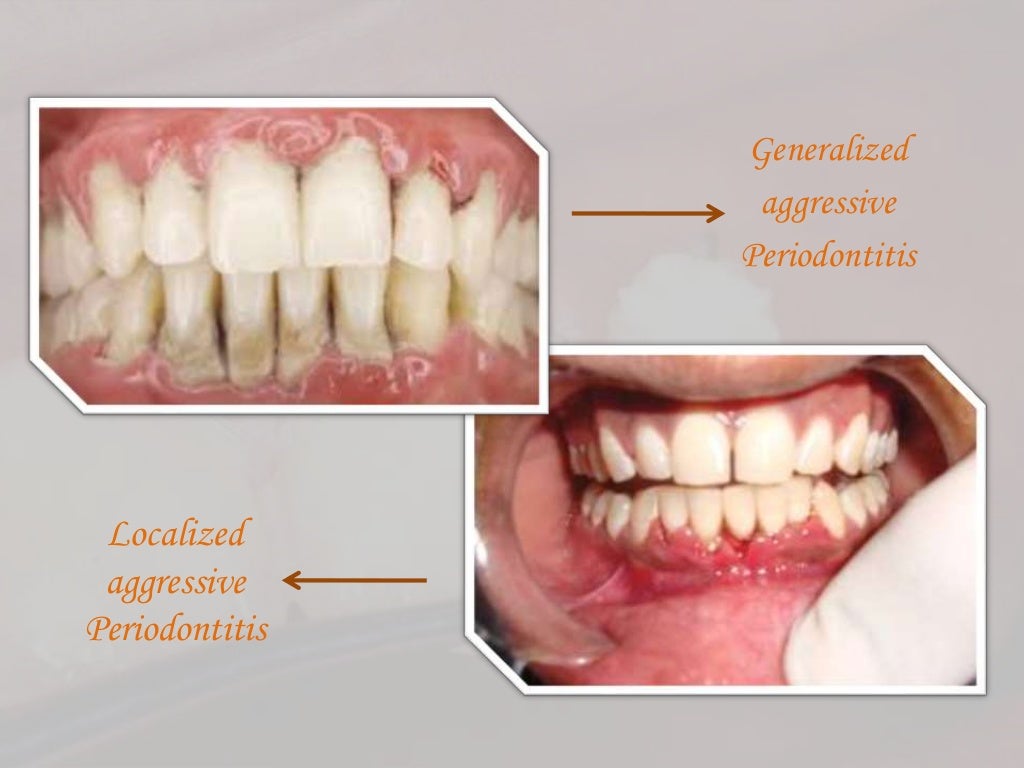 Dental plaque formation