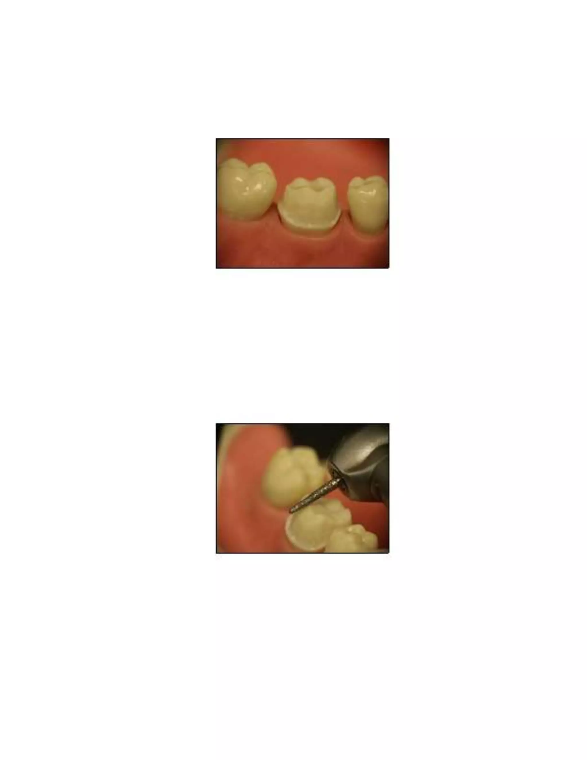 Full Crown Preparation and Some Clinical Modification PREPARION | DOCX