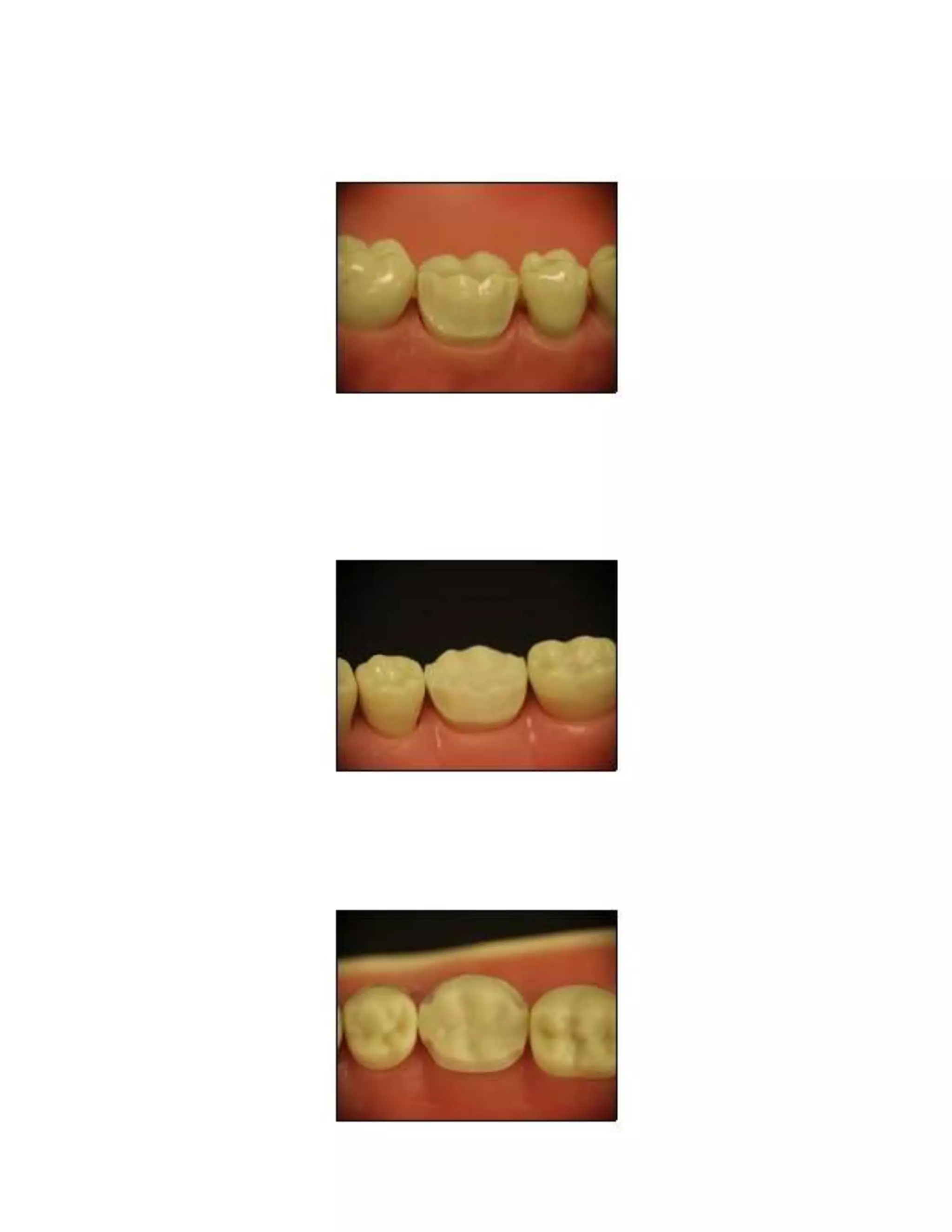 Full Crown Preparation and Some Clinical Modification PREPARION | DOCX