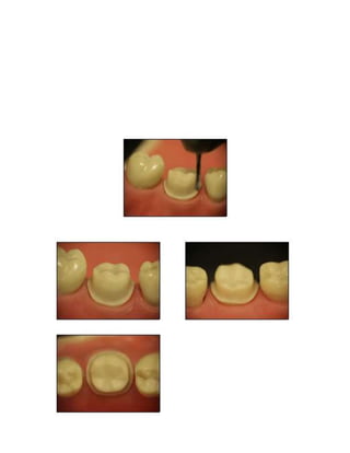 Full Crown Preparation and Some Clinical Modification PREPARION | DOCX