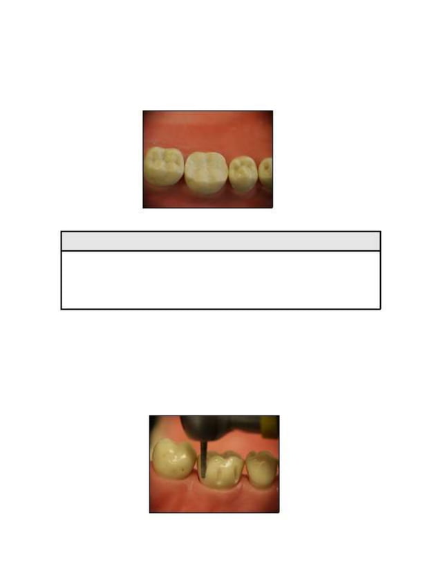 Full Crown Preparation and Some Clinical Modification PREPARION | PDF