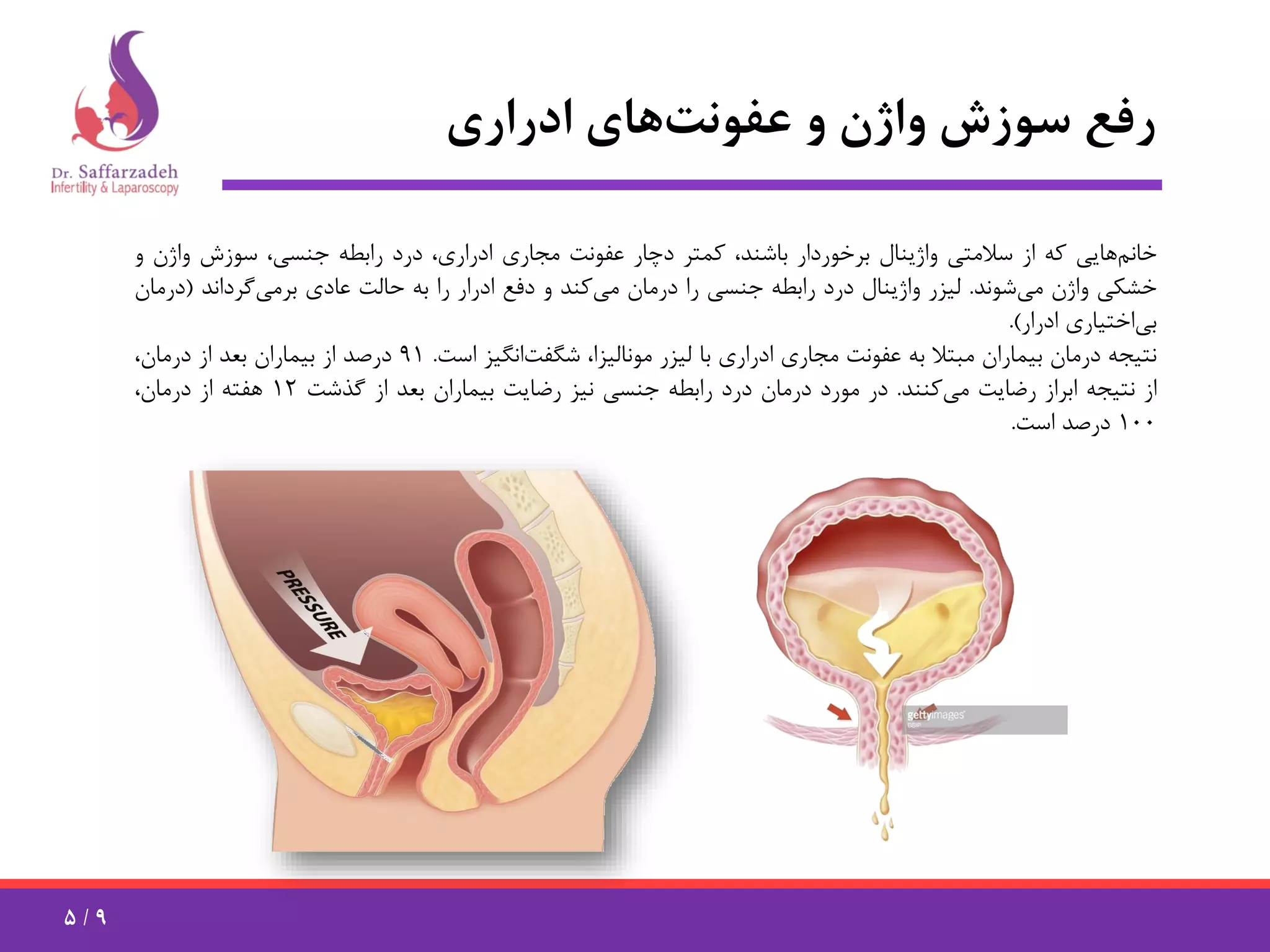دکتر صفارزاده لیزر مونالیزا جوان سازی واژن و درمان خشکی واژن Ppt