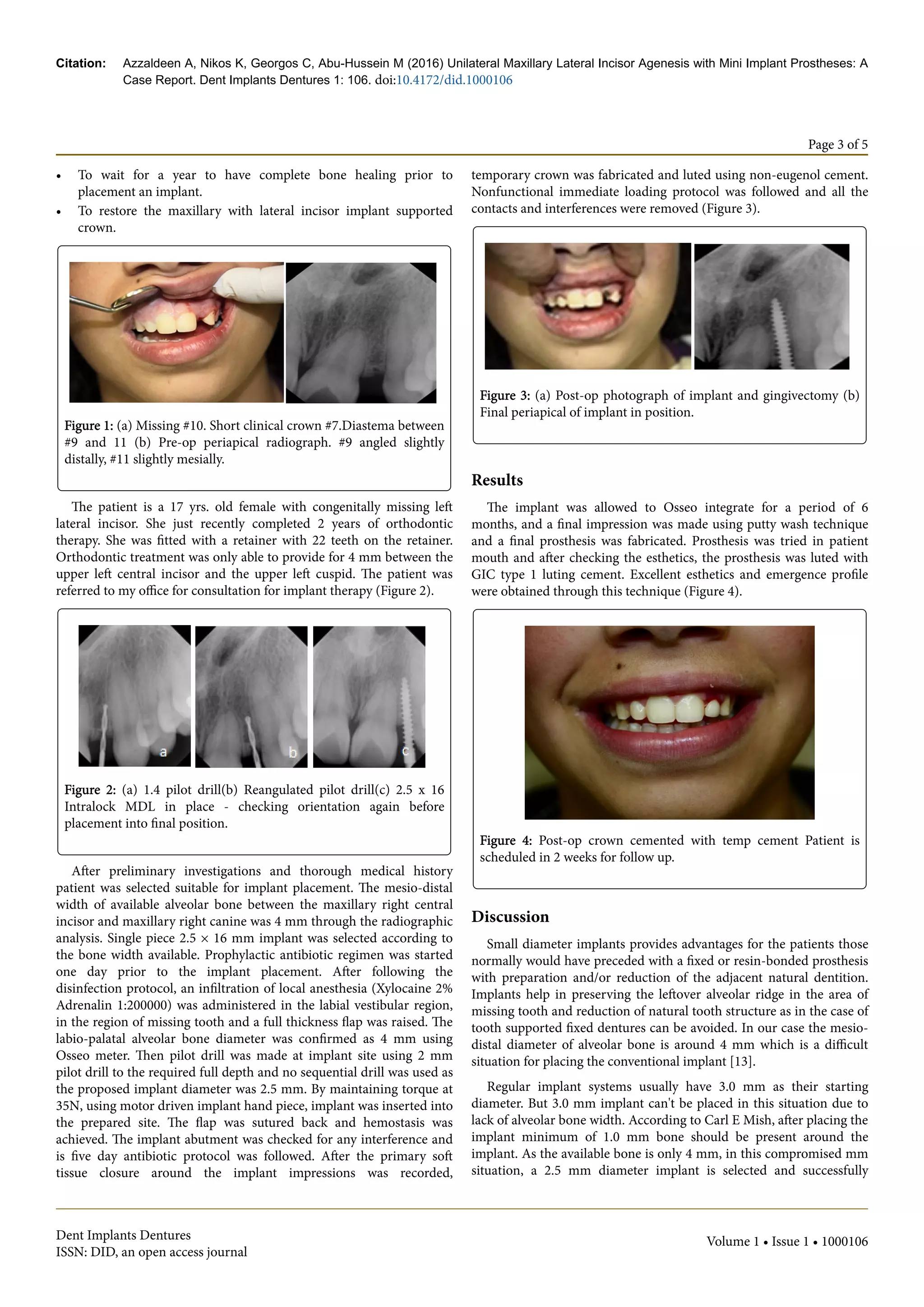 Unilateral Maxillary Lateral Incisor Agenesis with Mini Implant Prostheses: A Case Report | PDF