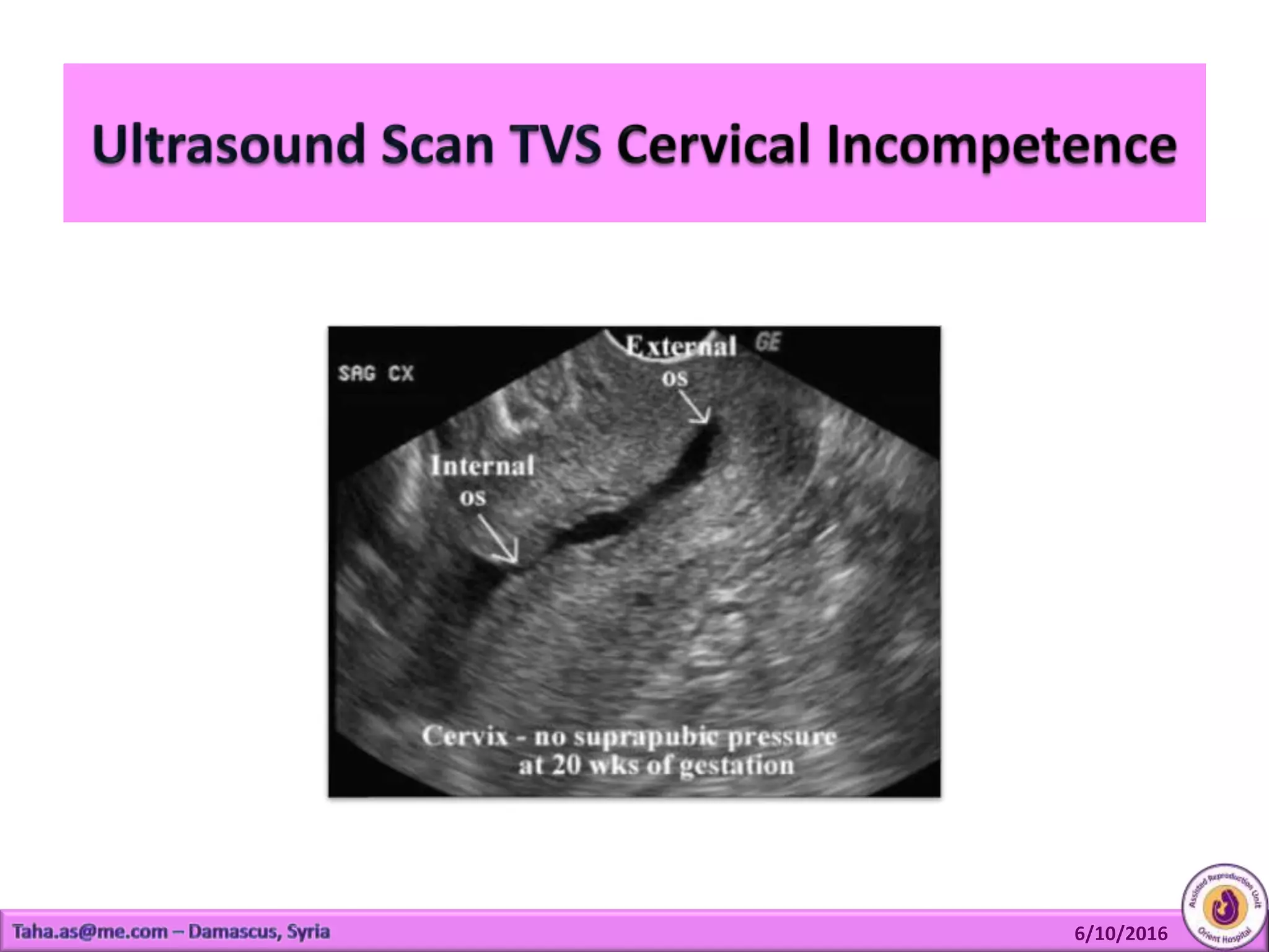 Cervical Incompetence | PPTX