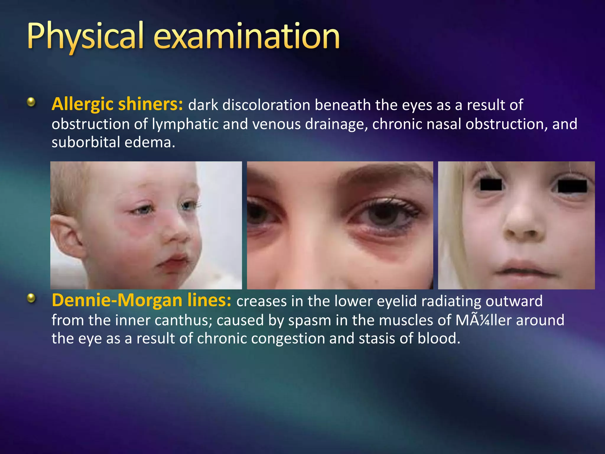 Asthma & allergic rhinitis | PPTX