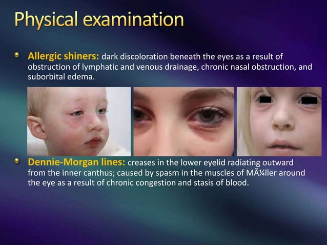Asthma & allergic rhinitis | PPTX