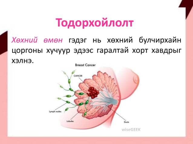 Хөхний хорт хавдар Ppt