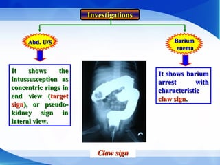 Intestinal Obstruction 2 | PPT