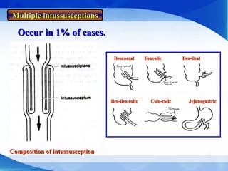 Intestinal Obstruction 2 | PPT