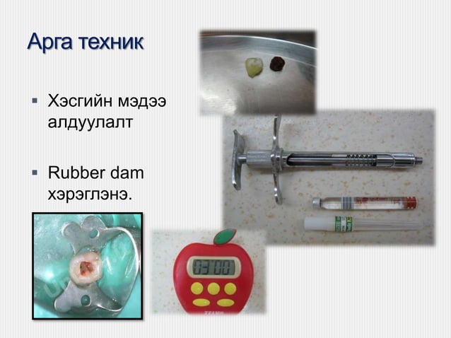 хүүхдийн сүүн шүдний зөөлцийн үрэвслийн эмчилгээ Pptx