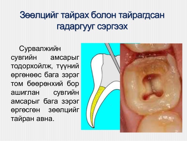 хүүхдийн сүүн шүдний зөөлцийн үрэвслийн эмчилгээ