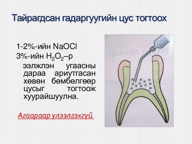 хүүхдийн сүүн шүдний зөөлцийн үрэвслийн эмчилгээ