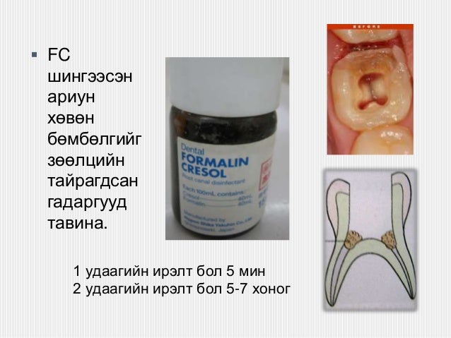 хүүхдийн сүүн шүдний зөөлцийн үрэвслийн эмчилгээ