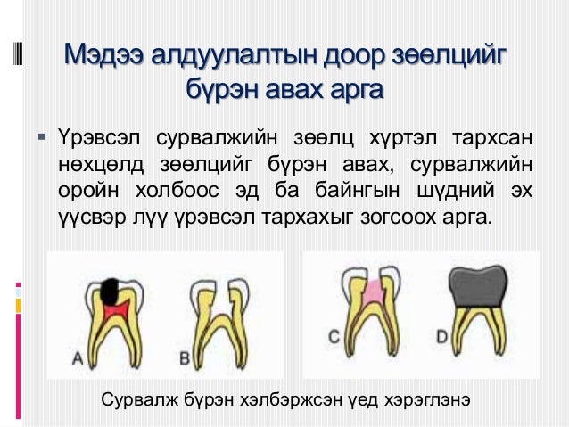 хүүхдийн сүүн шүдний зөөлцийн үрэвслийн эмчилгээ