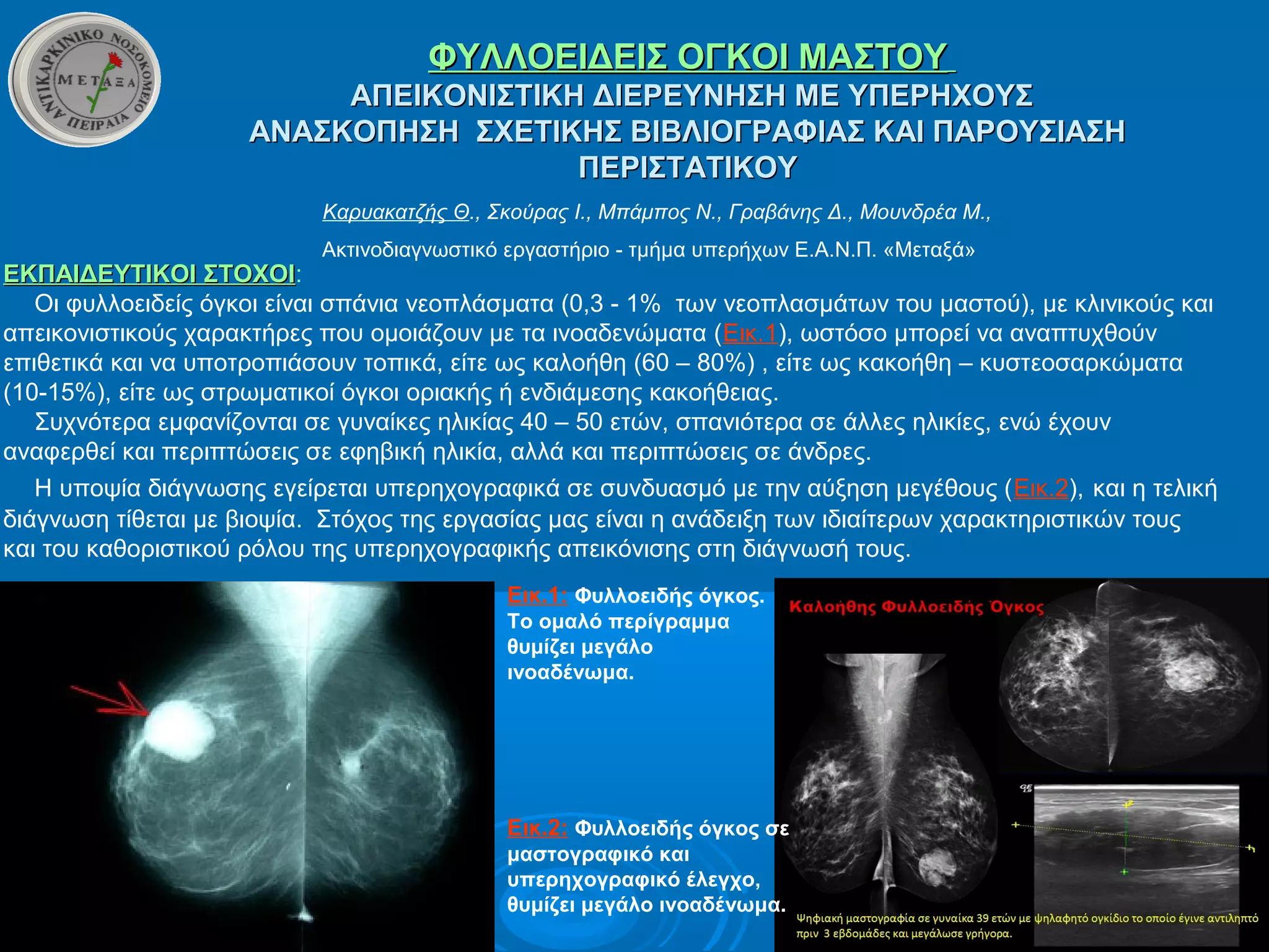 Φυλλοειδής όγκος μαστού | PPT