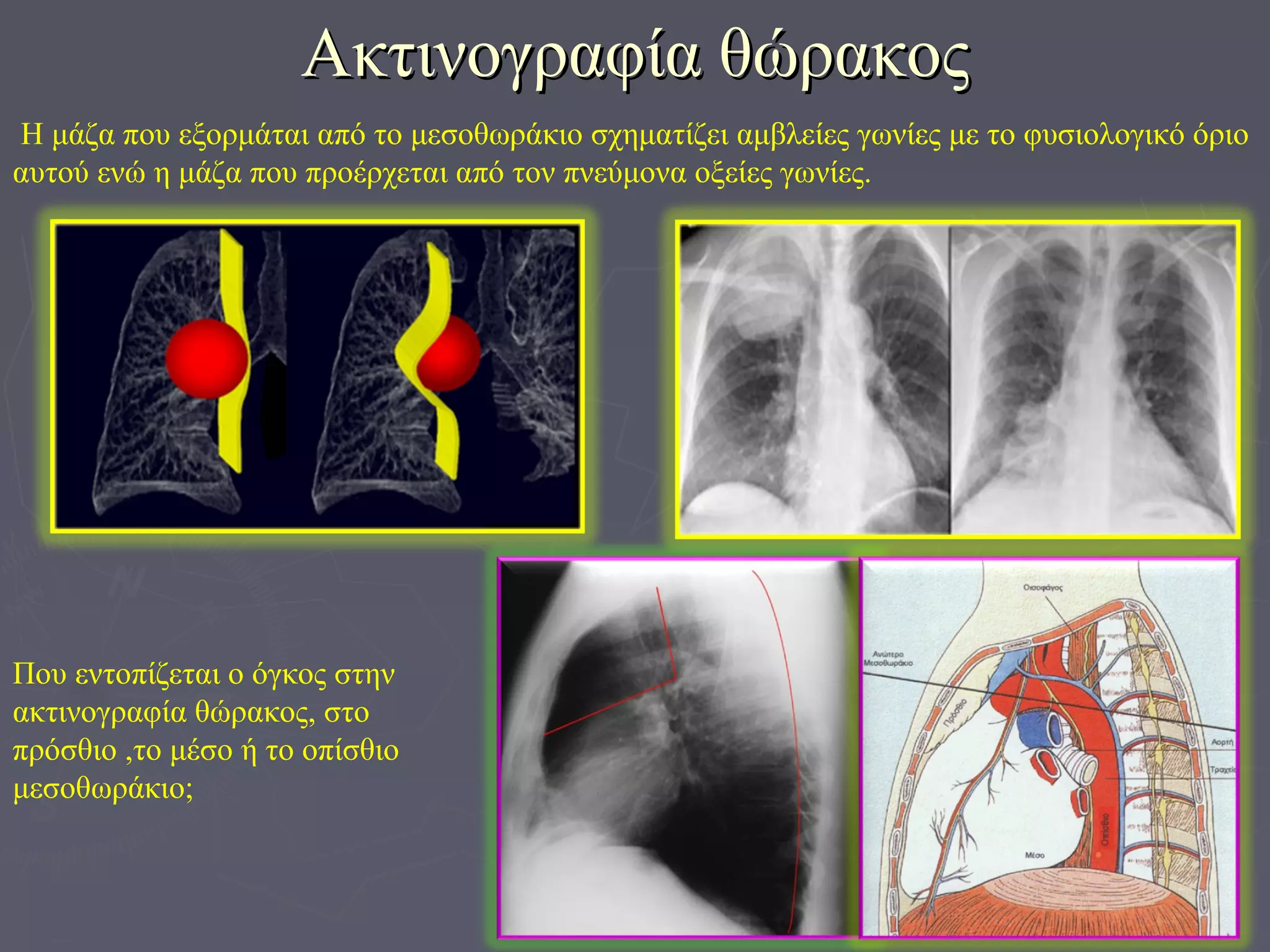Όγκοι μεσοθωρακίου | PPT