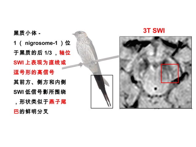swallow tail sign | PPT | Brain and Nervous System Disorders | Diseases ...