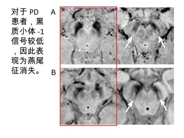 swallow tail sign | PPT | Brain and Nervous System Disorders | Diseases ...